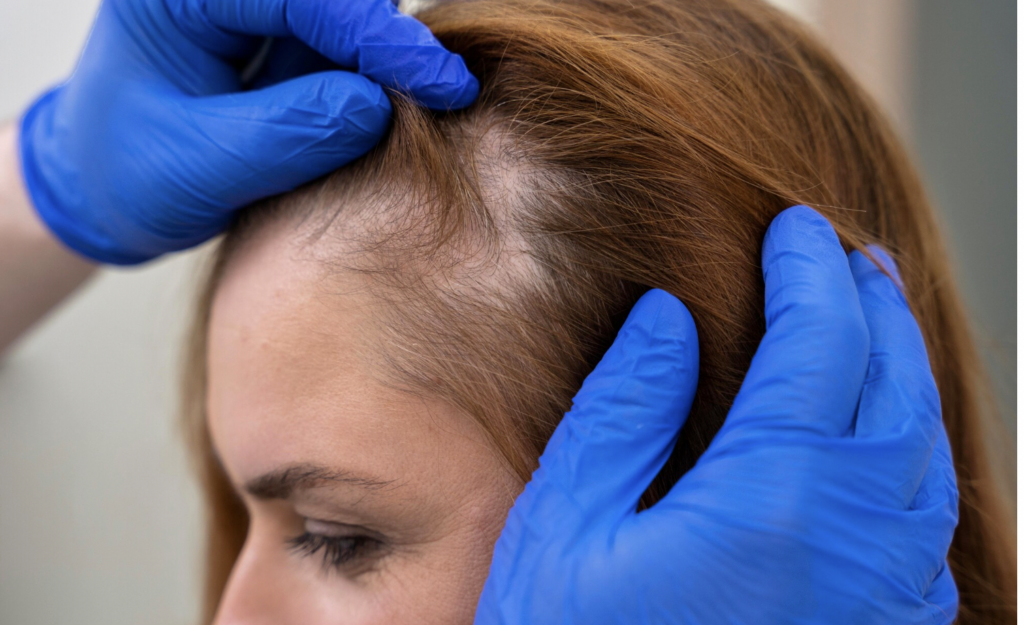 Understanding Alopecia Areata: Causes, Symptoms, and Treatment - Dr ...